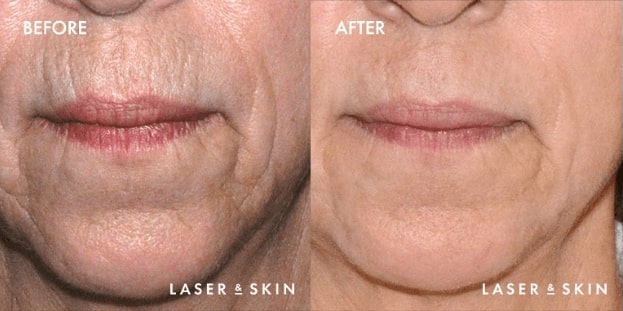 Fractional Ablative Laser | Fractional Skin Resurfacing | Sacramento CA