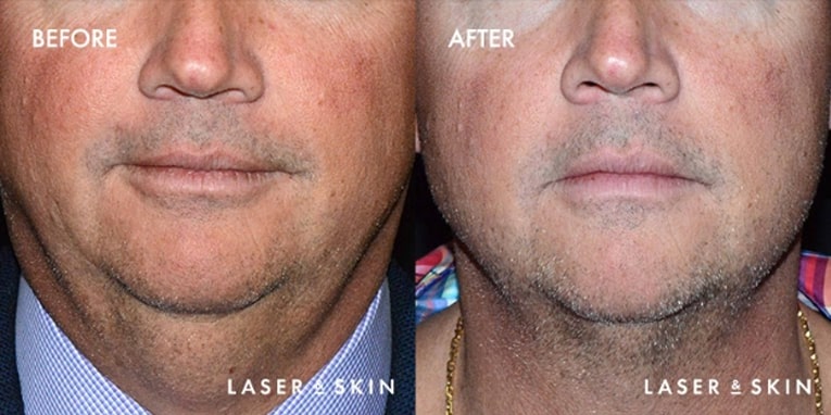 Laser & Skin Surgery Treatments Sacramento | Northern California