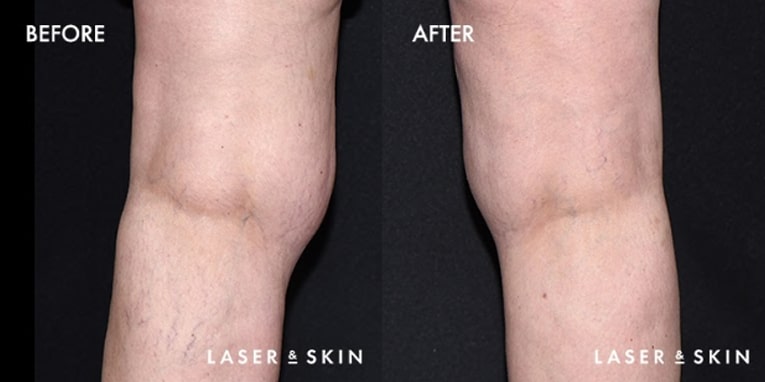 Laser & Skin Surgery Treatments Sacramento | Northern California