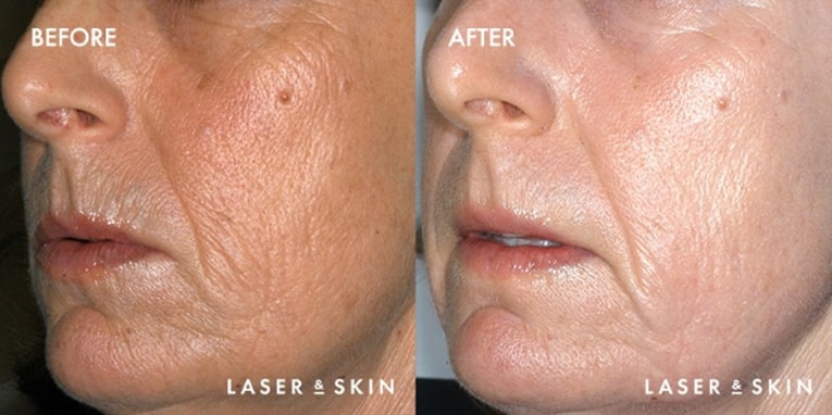 Laser & Skin Surgery Treatments Sacramento | Northern California