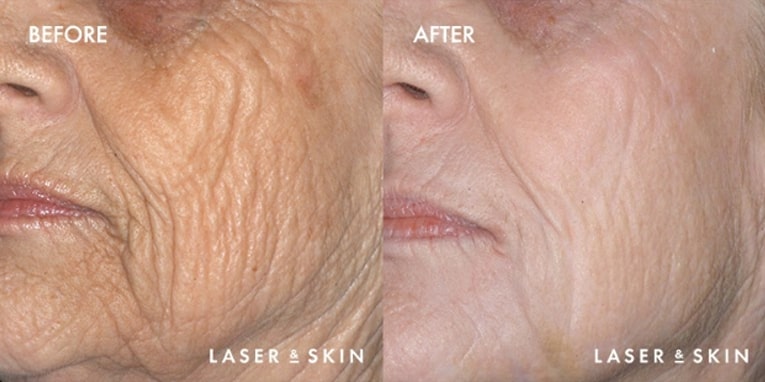 Laser & Skin Surgery Treatments Sacramento | Northern California