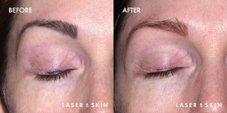 Laser & Skin Surgery Treatments Sacramento | Northern California