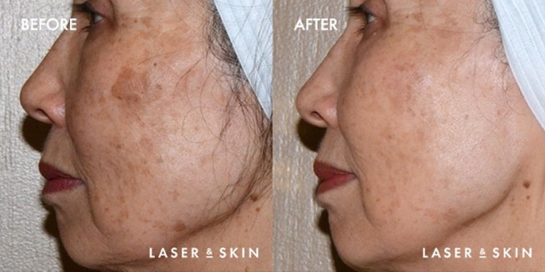 Laser & Skin Surgery Treatments Sacramento | Northern California