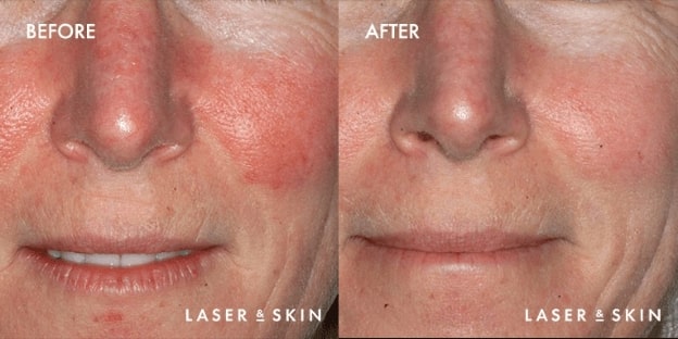 Laser & Skin Surgery Treatments Sacramento | Northern California